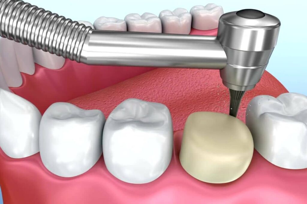 How Long Does a Dental Crown Procedure Take? | Spearmint Dental ...